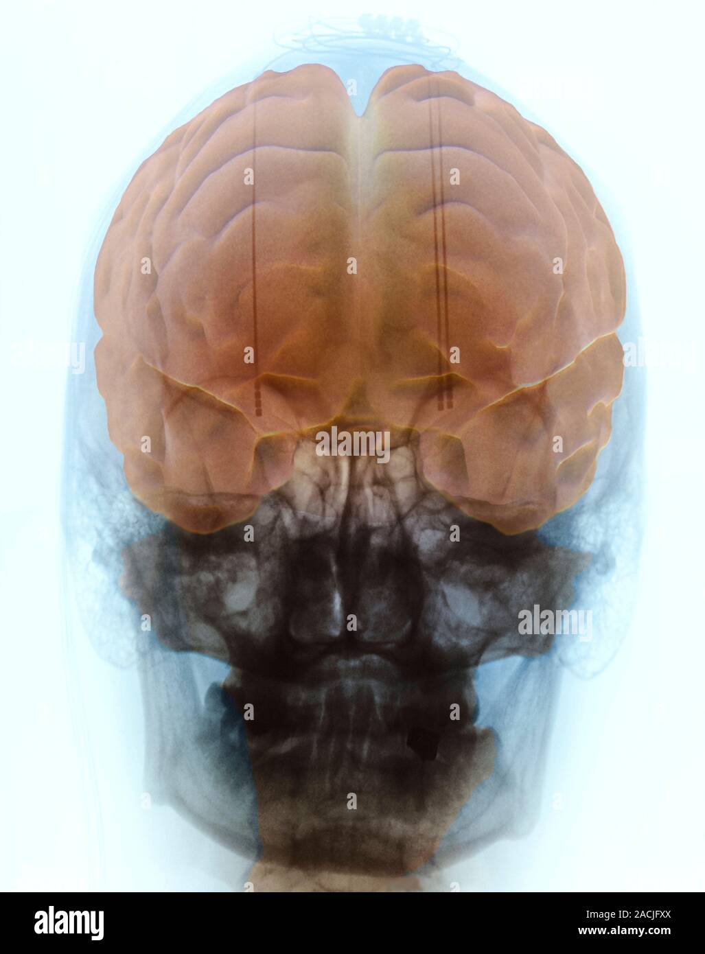 Coloured three-dimensional (3D) magnetic resonance imaging (MRI) scan in front view of the brain ...